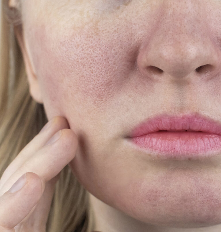 Enlarged Pores Treatment | Infinity Med Spa